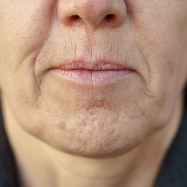 Cobblestone Chin Treatment | Improve 'Orange Peel' Chin