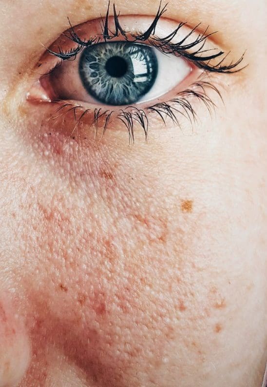 Oily Skin Treatment London | How to Treat Oily Skin