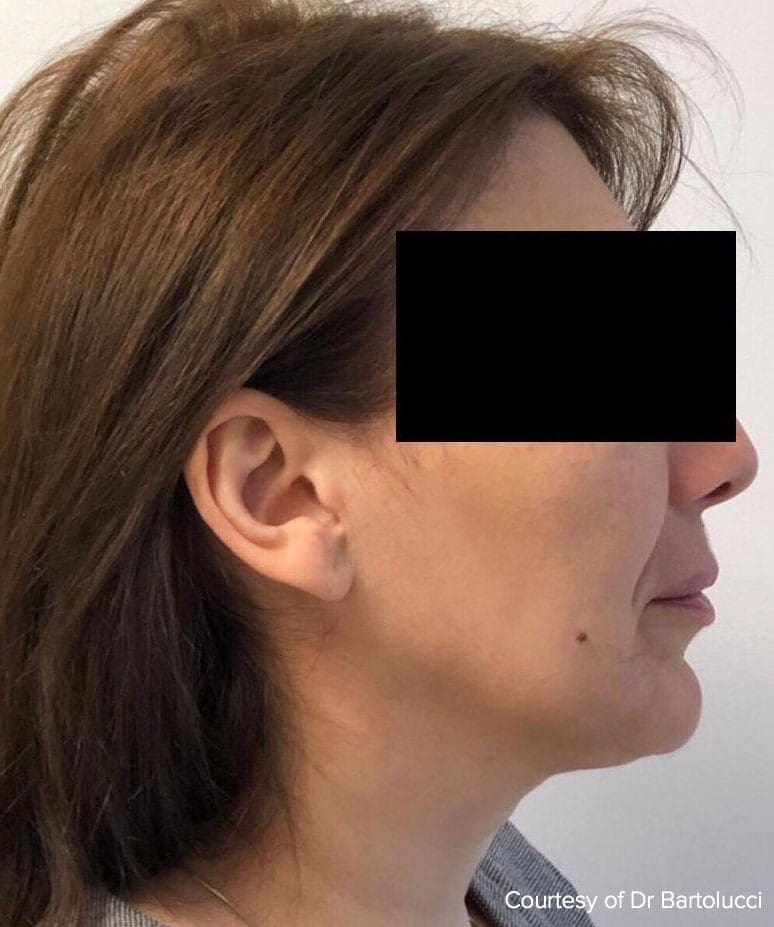 Profound RF | Dr Tatiana Lapa | Harley St Aesthetic Specialists