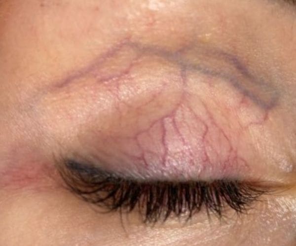 Eyelid / Periorbital Vein Laser | Drs Tatiana + Rishi Aesthetics